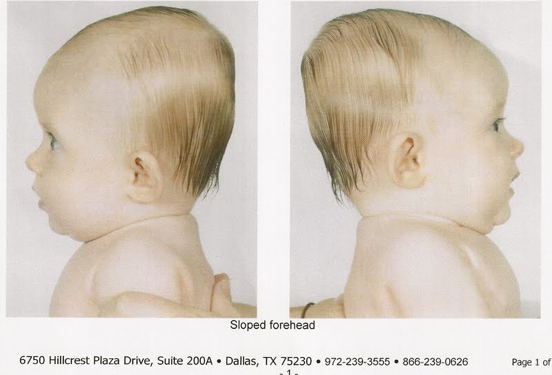 Casey and Lauren Coats: Plagiocephaly