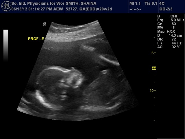 Post Smith: 20 Weeks and Anatomy Scan!