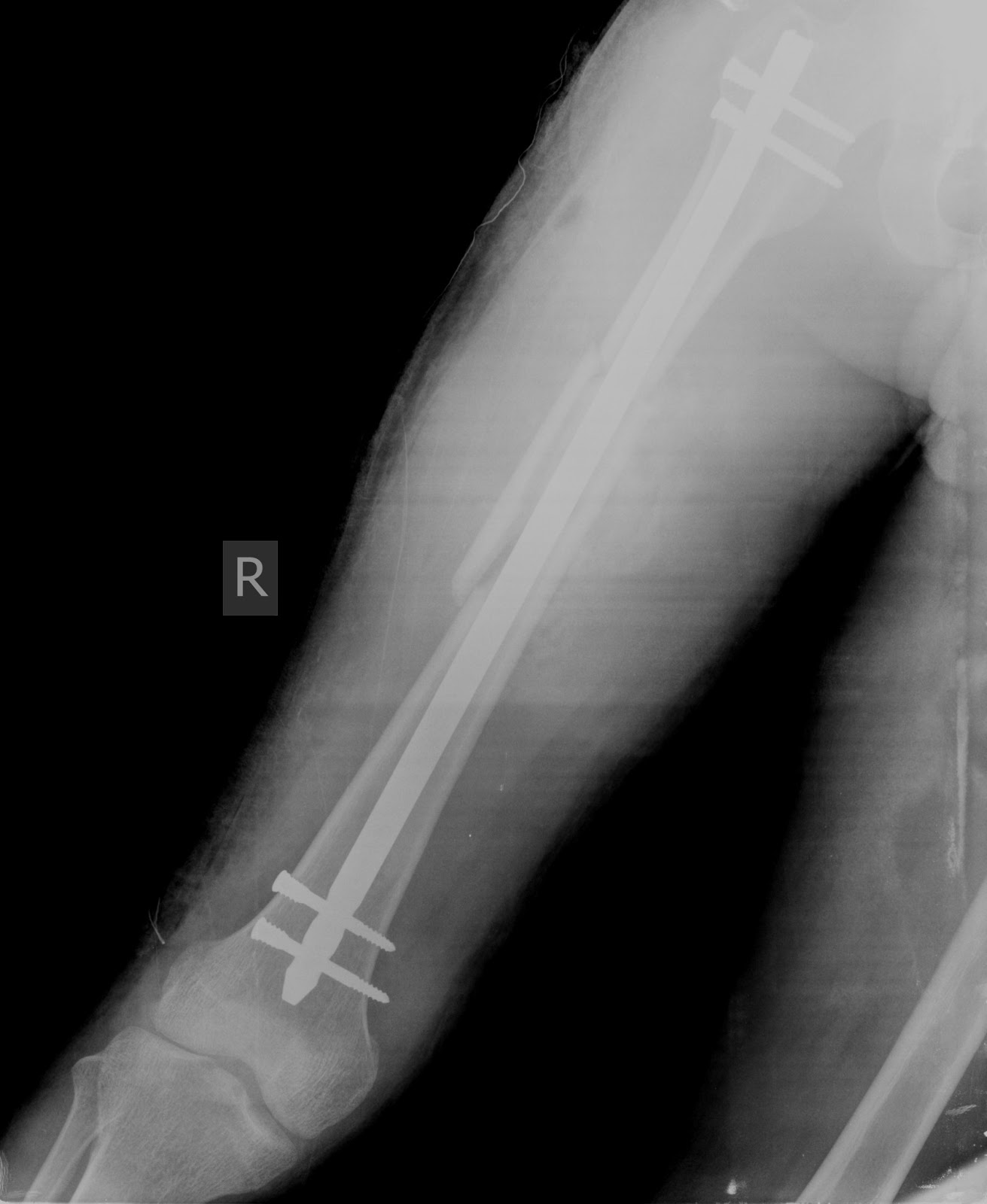 Venture Forth: The SIGN Nail