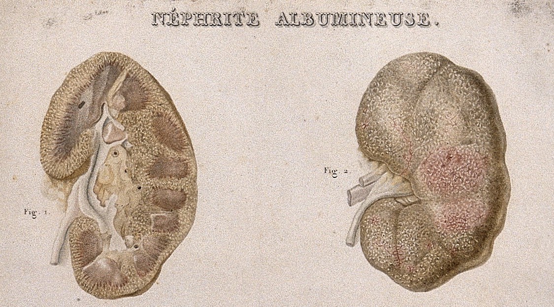 Renal biopsy becomes mainstream, 1954 – History of Nephrology