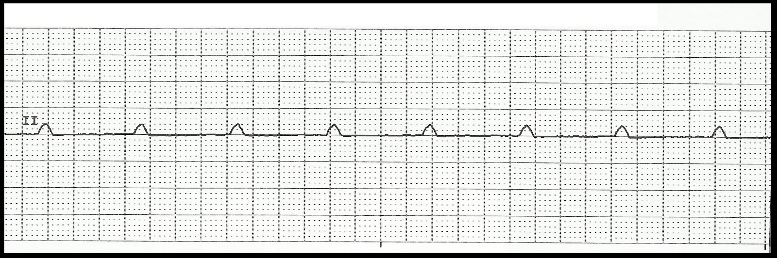 Basic EKG Rhythm Test 32