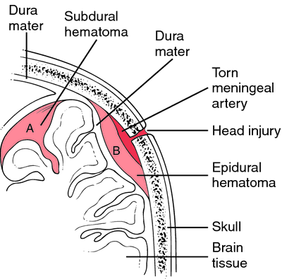 Paramedic Student Central: Subdural and Epidural Hematoma