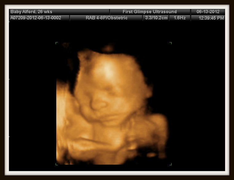 Us + Two: 25 Weeks 6 Days- 3D Ultrasound