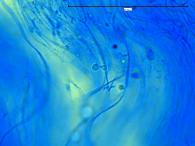 Fun With Microbiology (What's Buggin' You?): Sarocladium kiliense