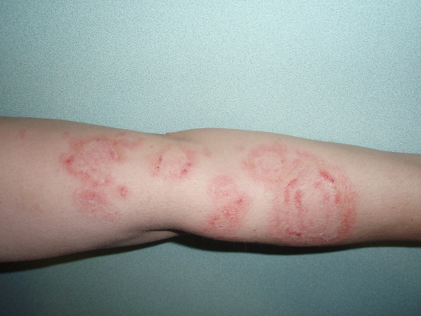 ¿Qué es lupus? - La Región