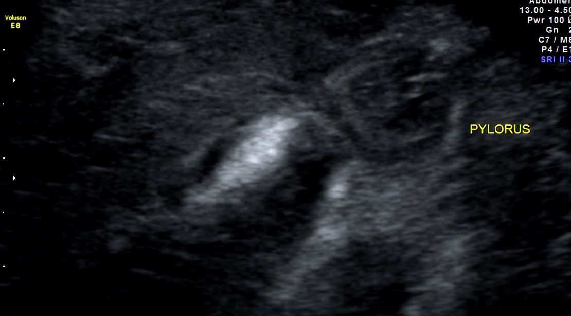 Whirlpool Sign-Ultrasound - Sumer's Radiology Blog