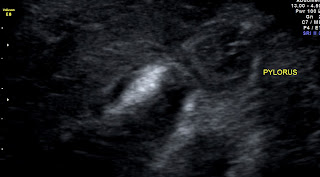 Whirlpool Sign-Ultrasound - Sumer's Radiology Blog