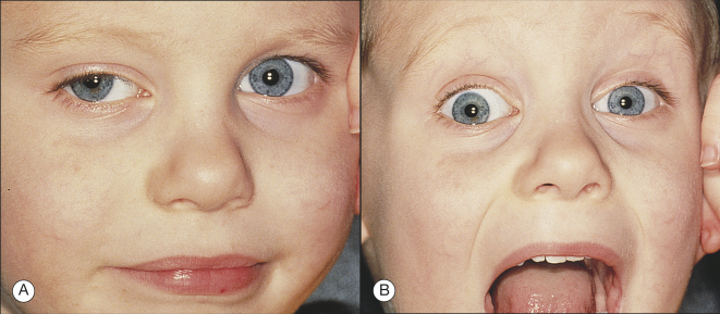 Ophthalmology Network: MARCUS GUN JAW-WINKING PHENOMENON : REVIEW ARTICLE