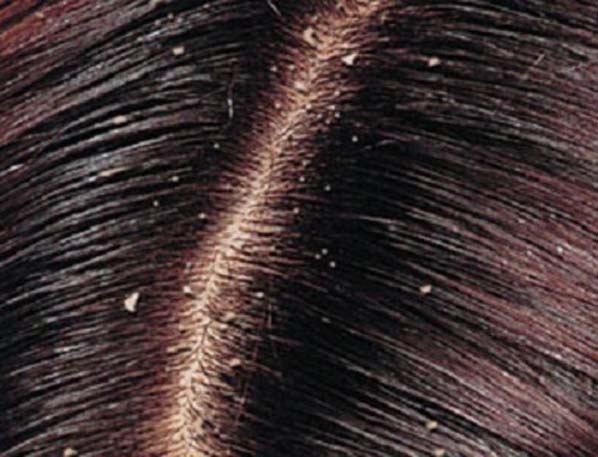 DERMATITIS SEBORREICA - CASPA - CALI