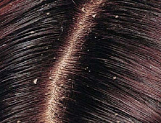 DERMATITIS SEBORREICA - CASPA - CALI