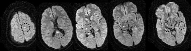 Dr Balaji Anvekar FRCR: Diffuse Axonal Injury MRI