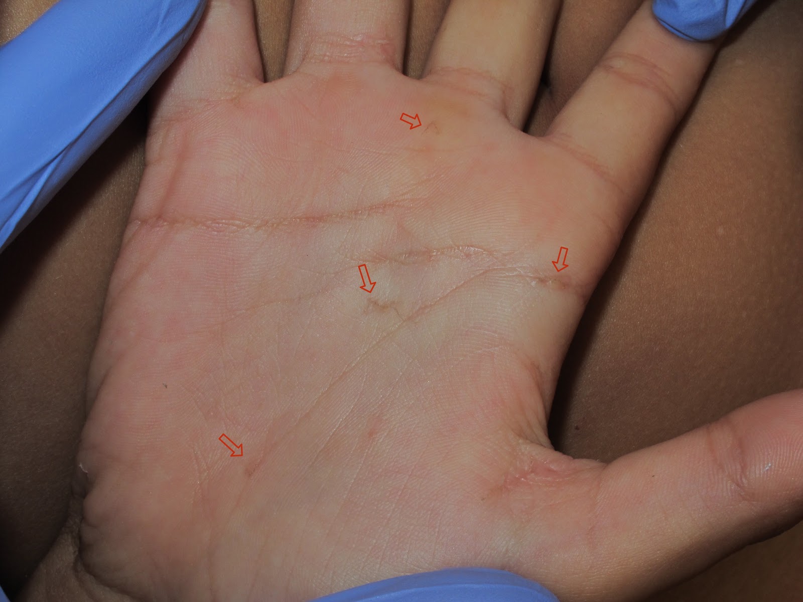 Dermapixel: Nódulos escabióticos: ¿reacción de hipersensibilidad o ...