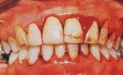 Pengertian dan Penjelasan kalkulus atau Karang Gigi