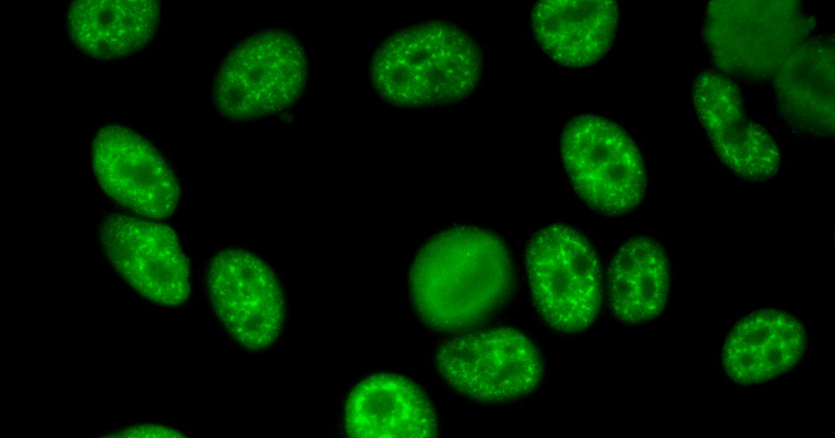 Anticorpos anti - Sm e anti - RNP