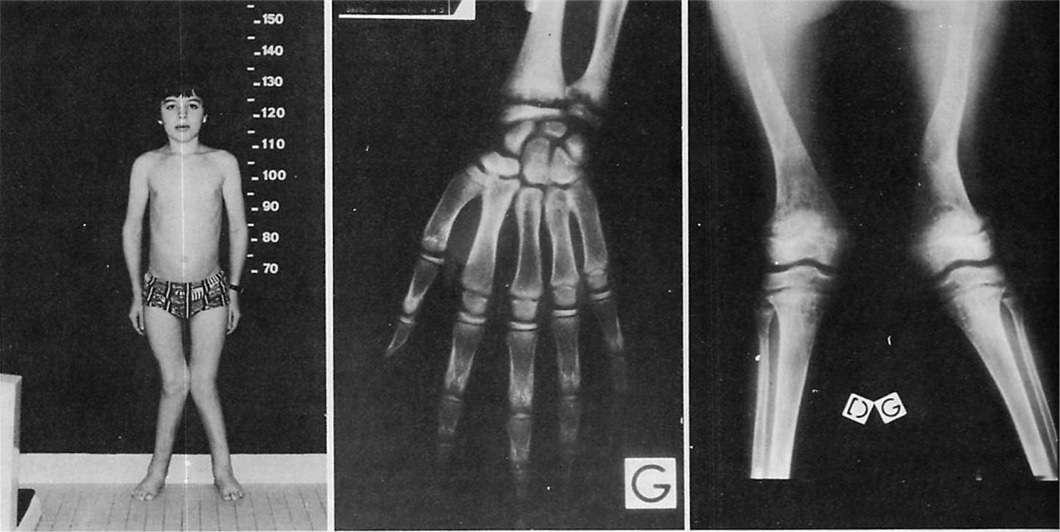 accouchement: Prévention du rachitisme carentiel