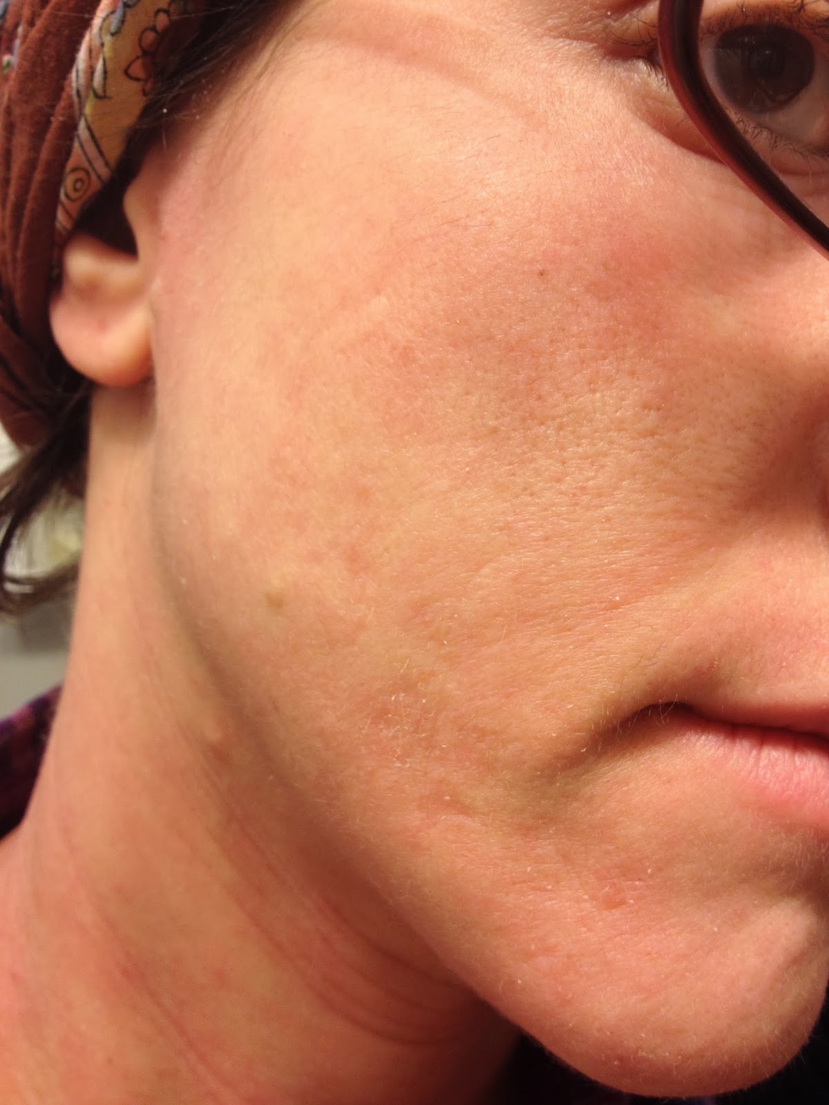 My journey with itchy skin.: Flare (mini-flare)? + pictures