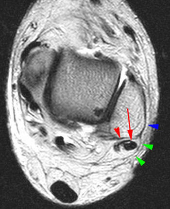 MRI Musculo-Skeletal Section: Normal anatomy of peroneus tendon on MRI