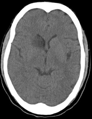 Dr Balaji Anvekar FRCR: Recurrent artery of Heubner Infarct