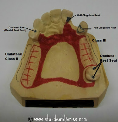 Stu-DENT Diaries: Fabrication of Removable Partial Dentures
