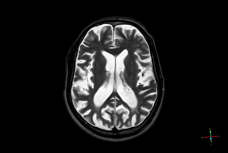 NPH and CSF flow studies - Radiology Imaging