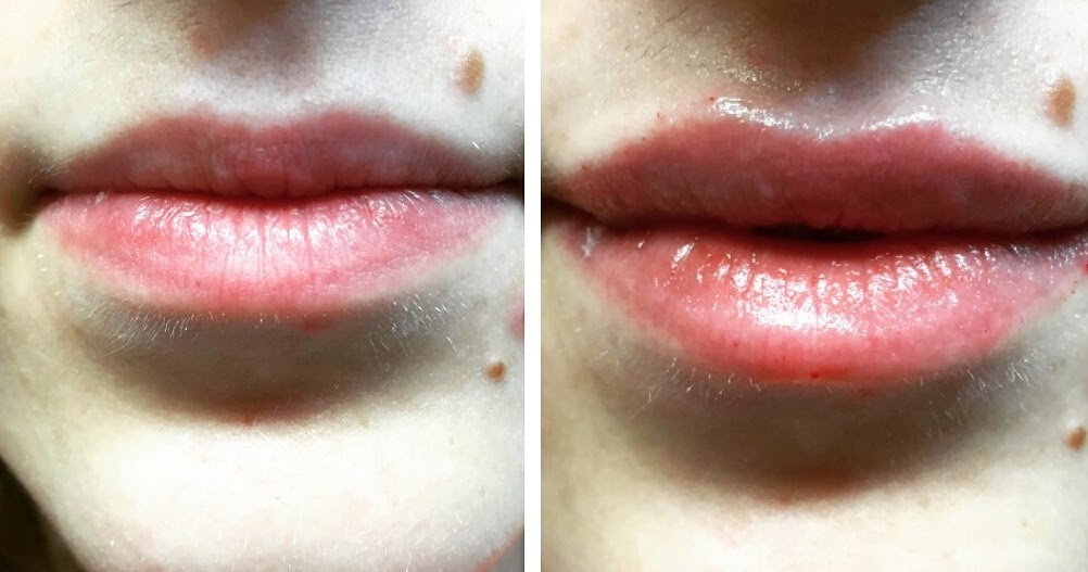 Selston Cosmetic Clinic: Lip Augmentation at Reputable Clinics ...