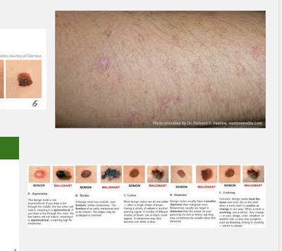 Skin Cancer – Know the Warning Signs - Saving Cancer Patients