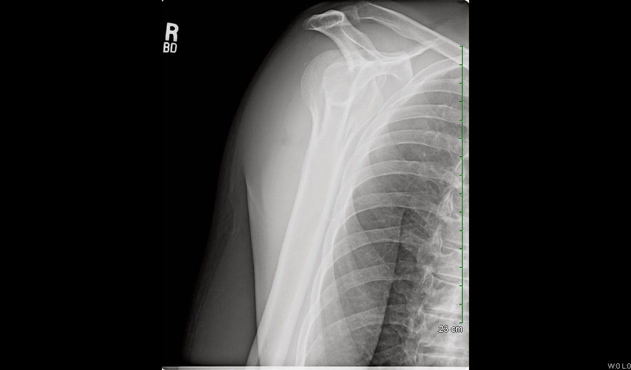 Shoulder and Elbow Surgery: Proximal humerus fracture - dislocation 2