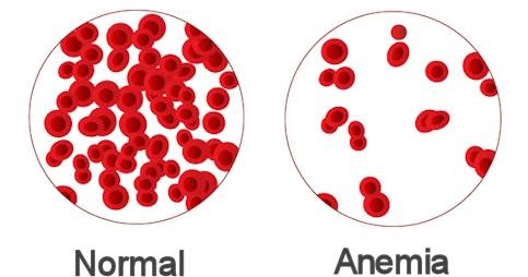 Anemia causes and detection methods