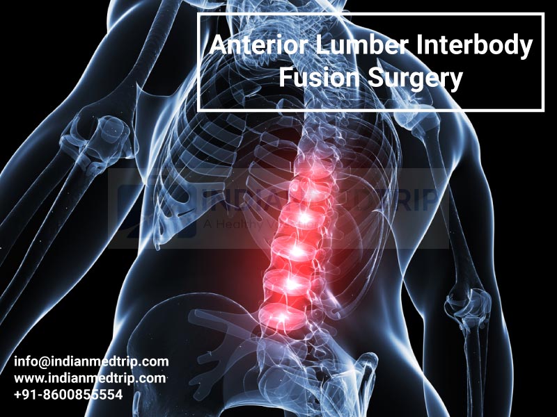 Anterior Lumbar Interbody Fusion Surgery ~ Healthcare In India