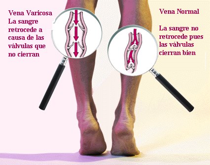 TU SALUD: Varices, ¿ Que son y porqué aparecen ? Remedios Naturales: