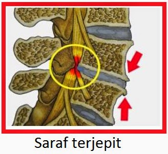 Saraf Terjepit | Info Kesehatan