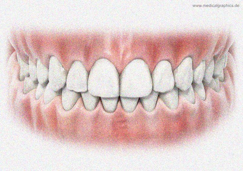La gencive - dentica club