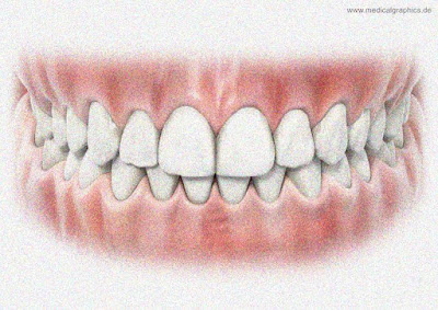 La gencive - dentica club