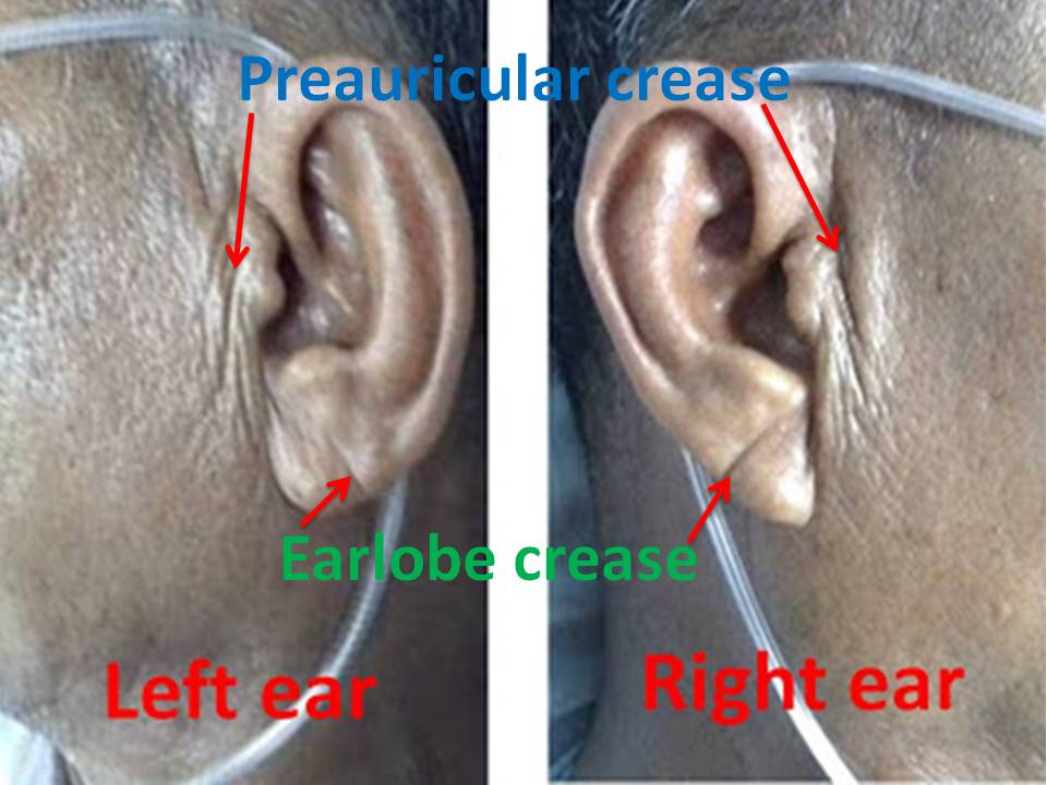 Phimaimedicine: 2,349 Spot diagnosis: Preauricular crease and earlobe ...