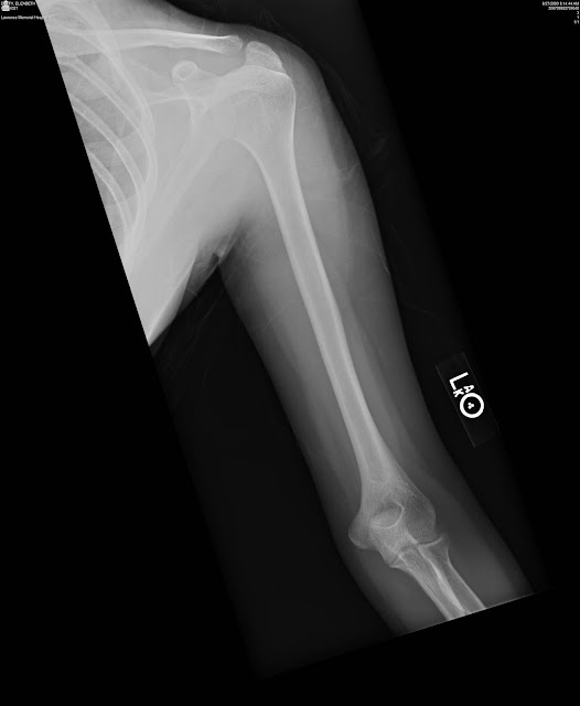 Mashing Myeloma: Little Line = Left Linear (Humeral) Lucent Lesion
