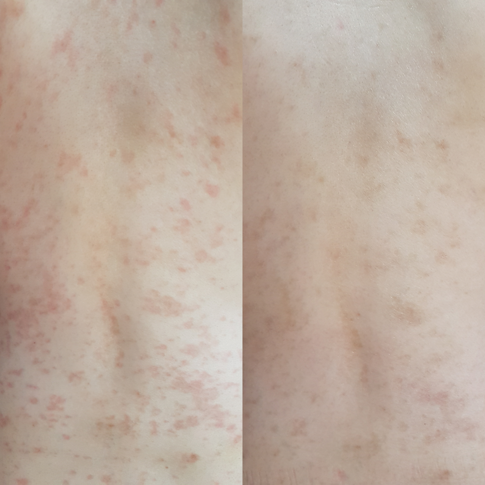 Patricia's story to tell: PUPPP - Skin rash due to pregnancy (in Bahasa ...