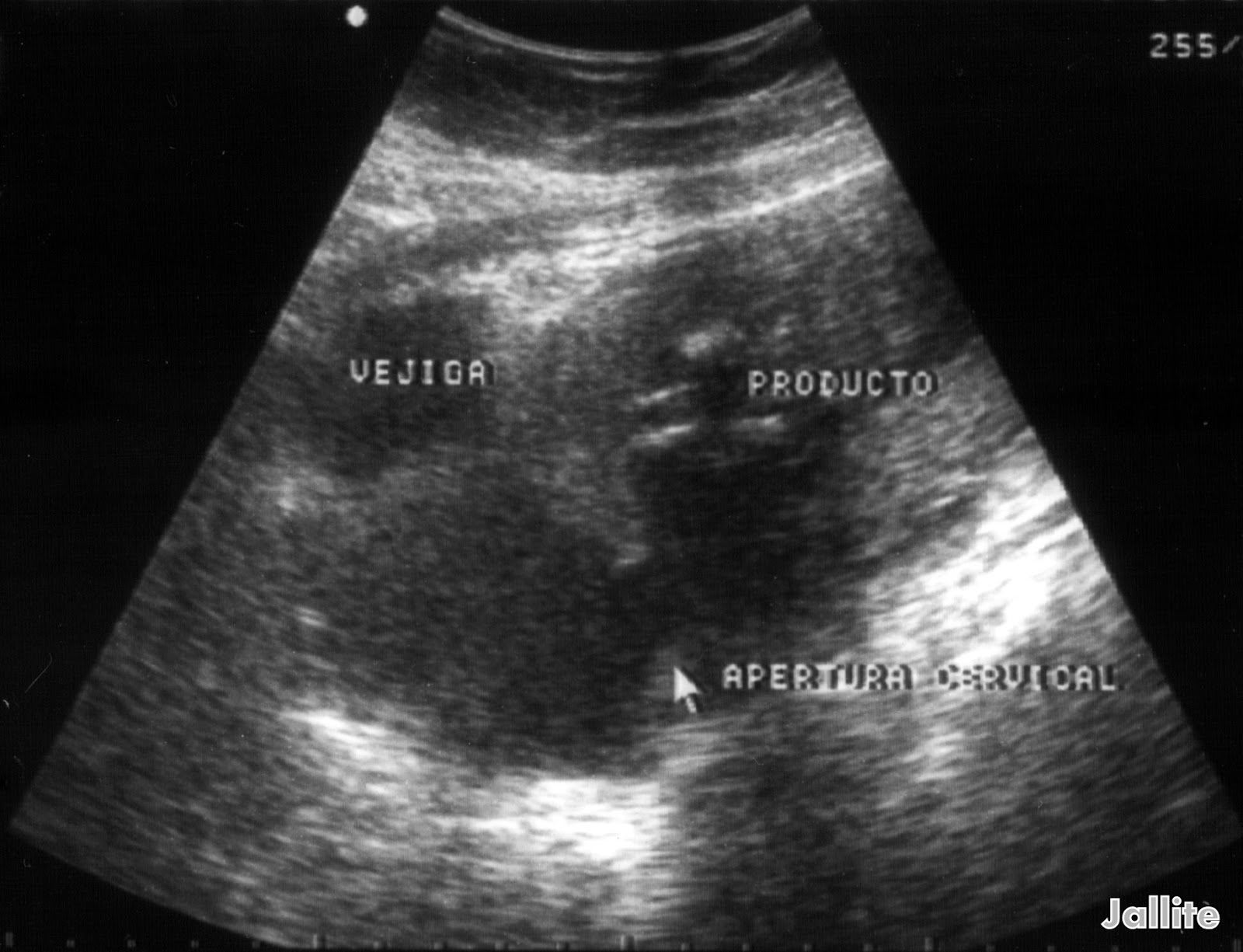 Incompetencia Cervical