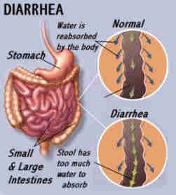 Health Care: Diarrhea