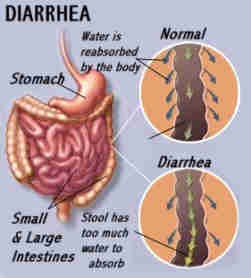 Health Care: Diarrhea