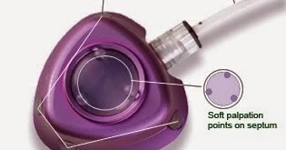 Star-fishing: Portacath, First Chemo treatment