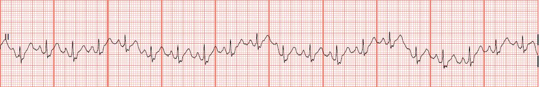EKG Rhythm Strip Quiz 64