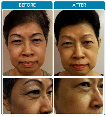 ageLOC Transformation