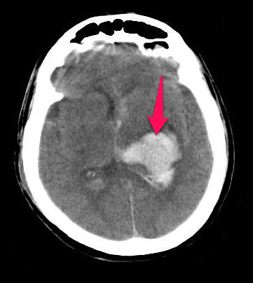 MedicoNotebook: Stroke