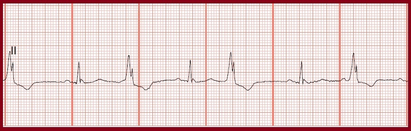 Practice EKG Rhythm Strips 189