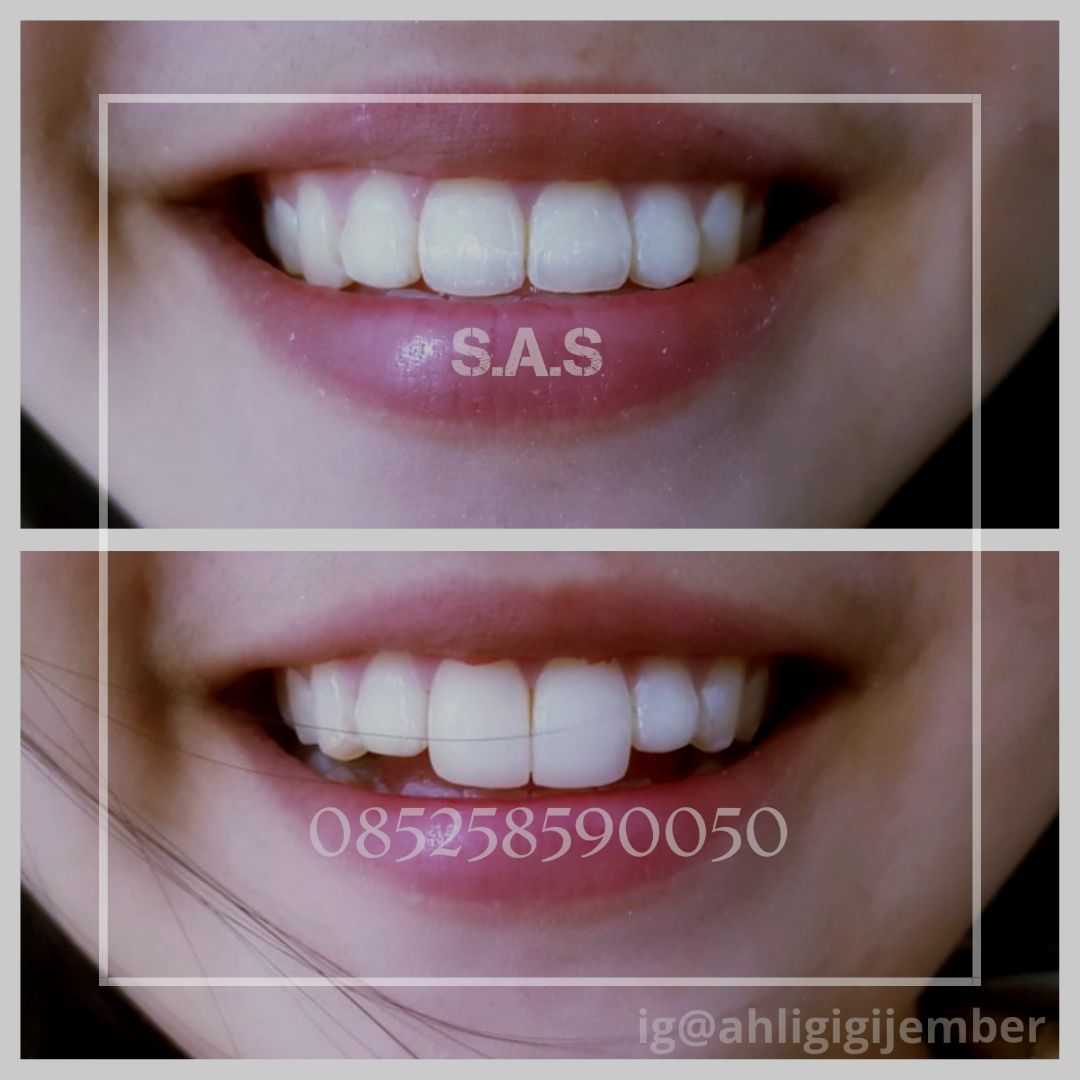 Senyum Cantik Gigi Kelinci (Bunny Smile) dan Hasil Perbaikan Gigi Depan ...