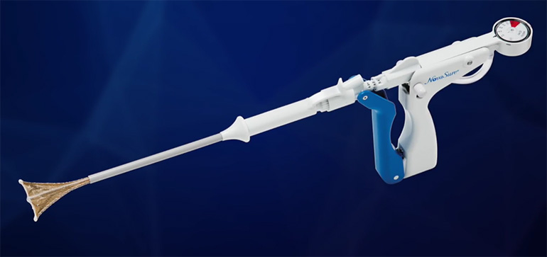 Ob/Gyn Updated : Next- generation NovaSure ADVANCED endometrial ...