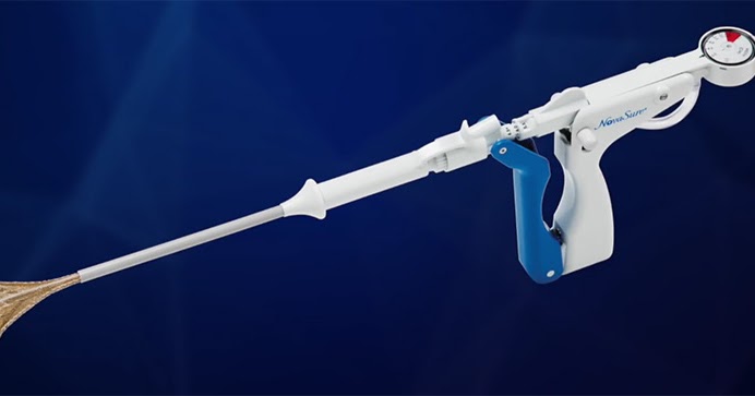 Ob/Gyn Updated : Next- generation NovaSure ADVANCED endometrial ...