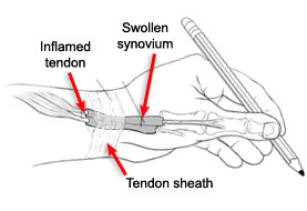 Physical Therapy DataBase: de Quervain's Tenosynovitis - Part I