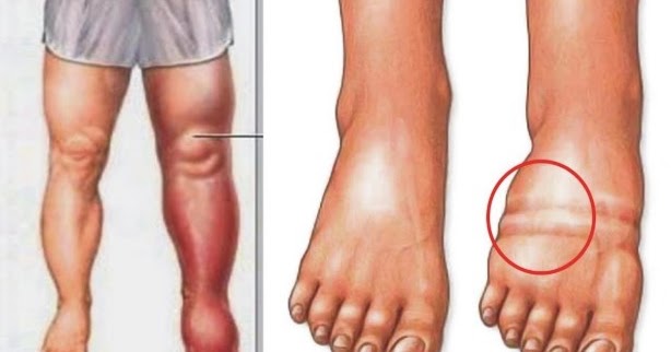 WHAT CAUSES WATER RETENTION AND HOW TO AVOID IT - The News Pins