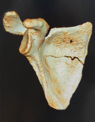 OSTEOLOGIA: Practico N°IV Osteología de MMS MMII